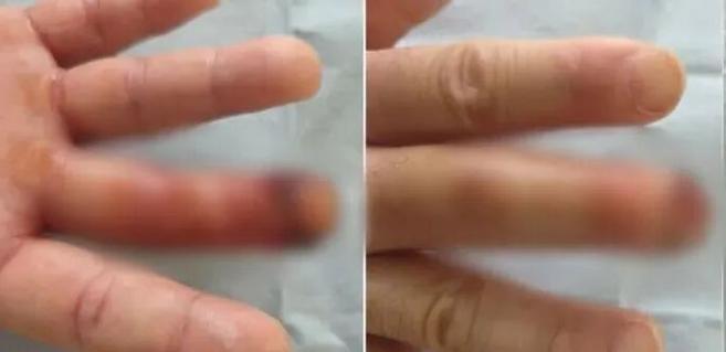指尖缺失一厘米恢复图