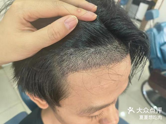为什么不建议植发图标