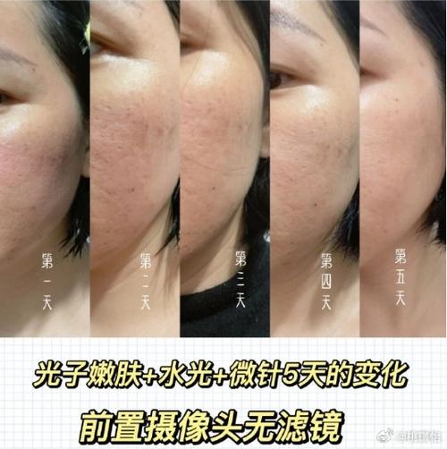 水光针好还是光子嫩肤好图标