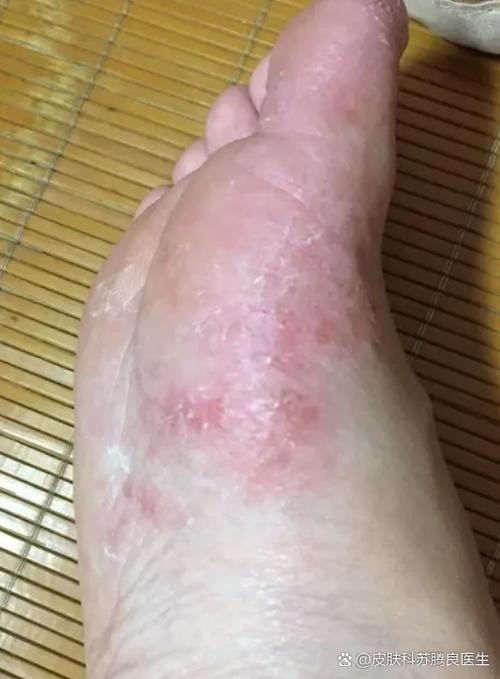 脚气真菌