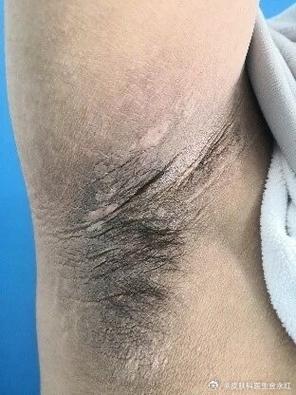 黑棘皮能治好吗截图