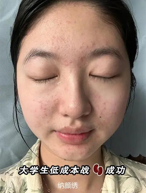 你女朋友说她长痘痘了图标