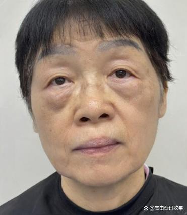 眼皮眼袋浮肿怎么消除截图