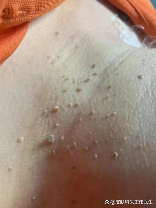 hpv乳头状图片图标