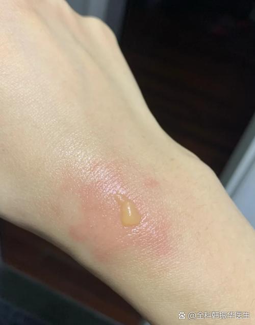 去烫伤红印最好的办法