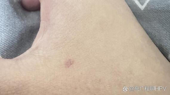 腹乳沟结节能喝酒吗截图