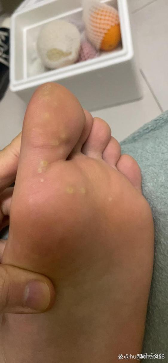 跖疣刚开始是什么样子图标
