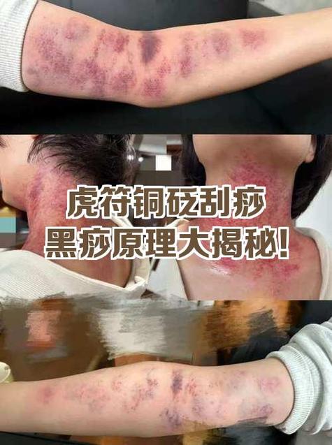刮痧的痧多久能消啊图标