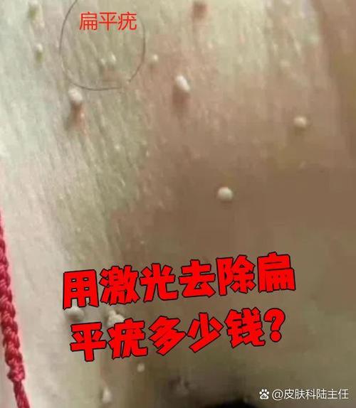 去瘊子多少钱一颗正规医院图标