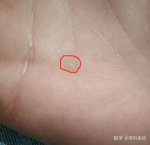 足疗技师手茧一招消除