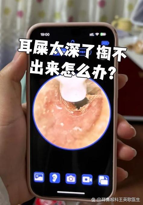 蓝牙耳机滤网被耳屎堵了图标
