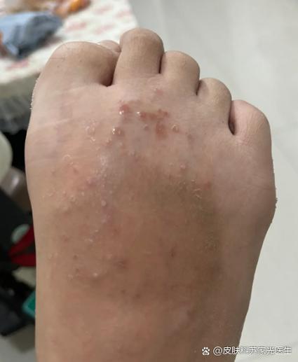 脚感染真菌图标