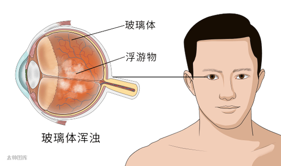 眼玻璃体混浊怎么治疗图标