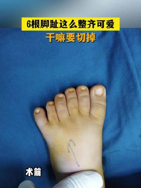六个脚趾头图片截图
