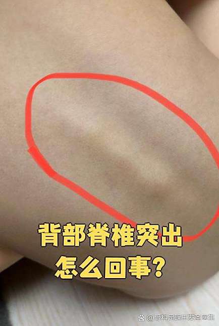 后背长了一个凸起硬包图标