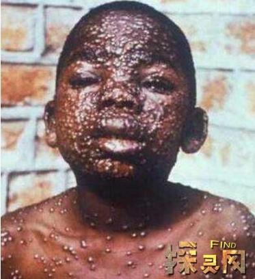 埃博拉是什么病毒图标