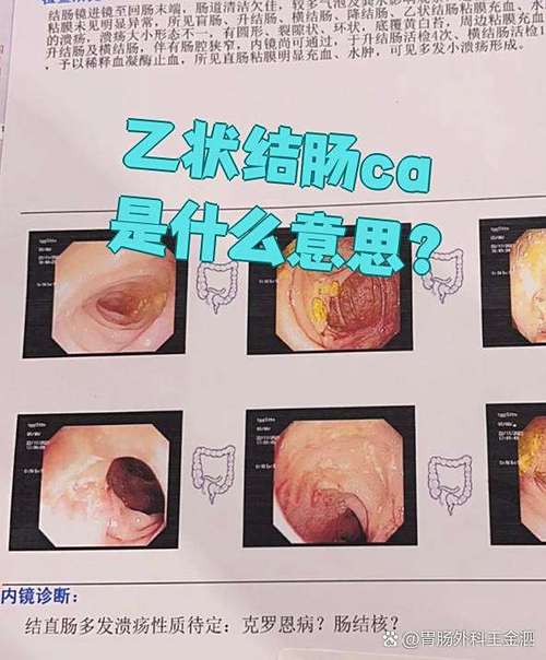 ca是良性还是恶性图标