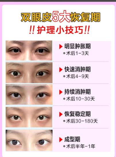 双眼皮做坏了多久能第二次修复图标