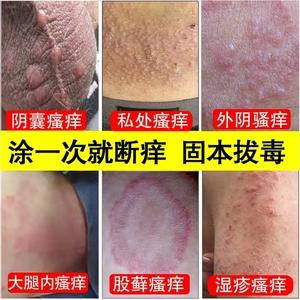 蛋皮痒怎么快速止痒图标