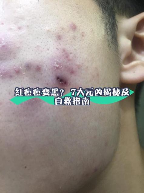 痘印变黑了怎么消除图标