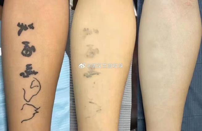 皮秒洗纹身能不能洗干净截图