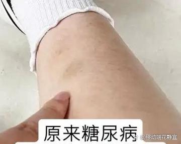 饿病是什么症状图标