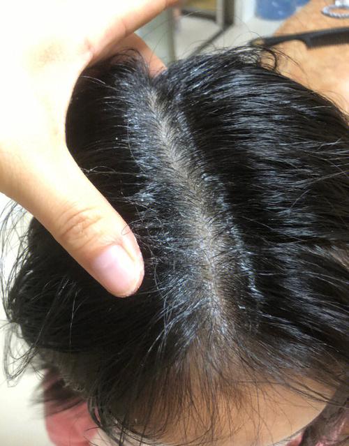 毛囊炎的治疗方法图标