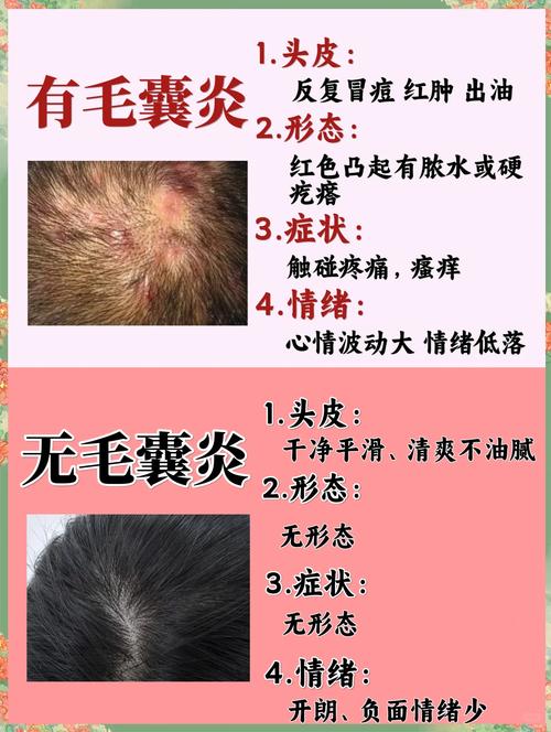 毛囊炎能自愈吗图标