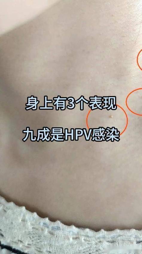 怎么清除hpv病毒图标