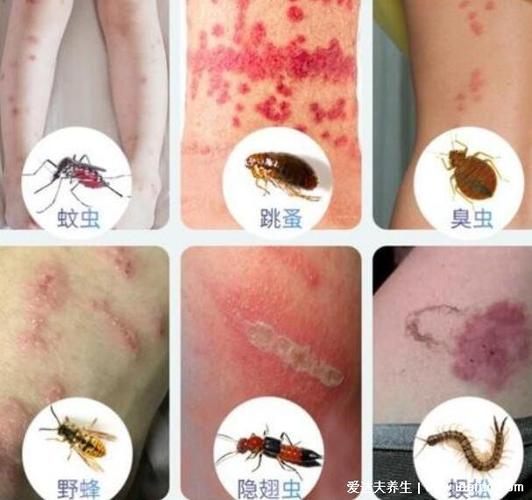 跳蚤咬后的症状图截图