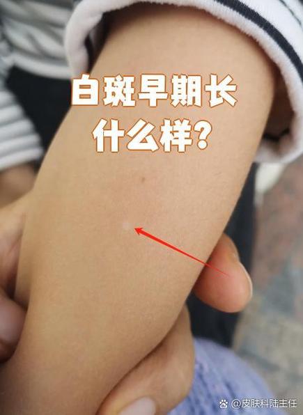 皮肤有白斑图片大全图标