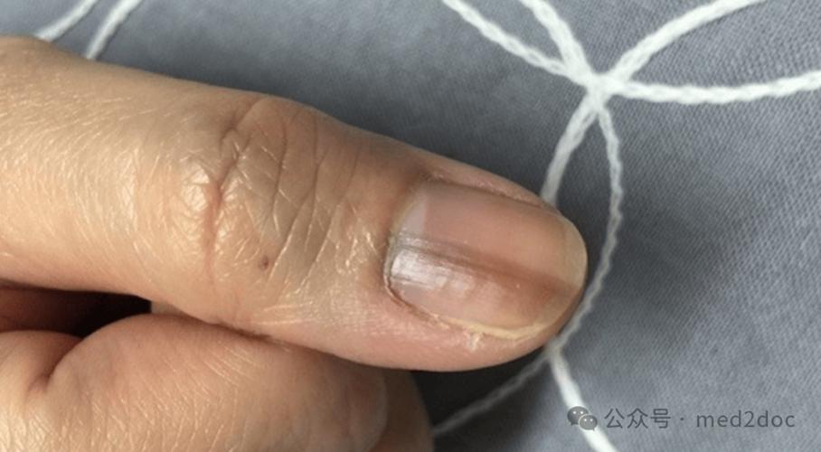食指黑线是癌症早期信号吗图标