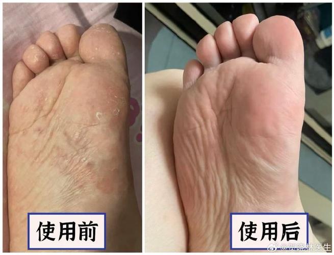 有脚气真菌感染用什么药合适图标