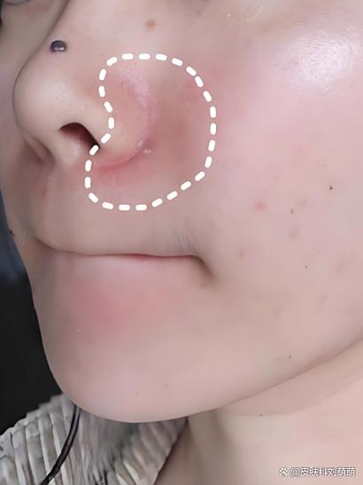 脸上爆皮掉屑是什么原因图标