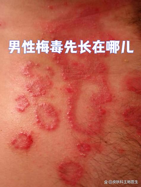 性疾病会传染给家人吗图标