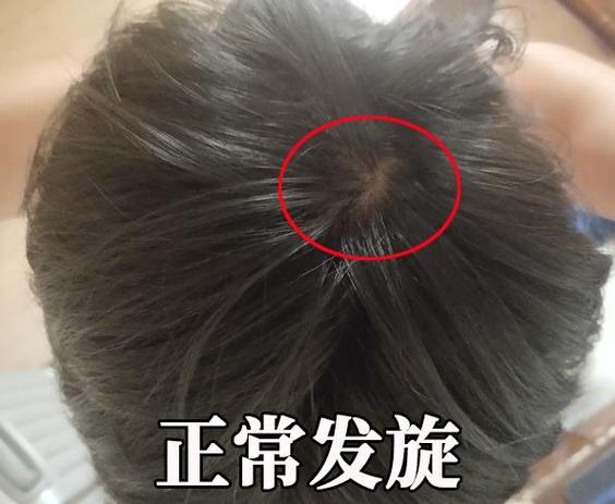 发旋掉头发是什么原因图标