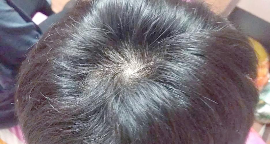旋哪里头发容易掉截图