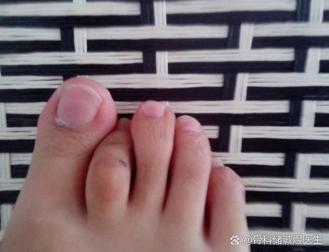 第二个脚趾弯曲图片图标