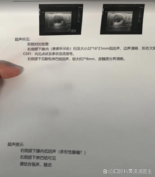 实性低回声包块是什么意思截图