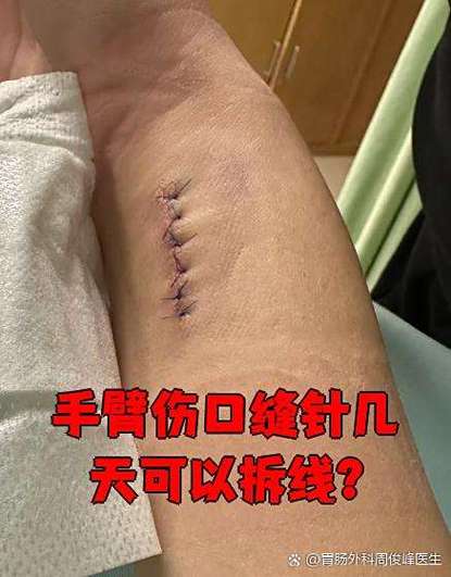 缝了针几天能拆线截图
