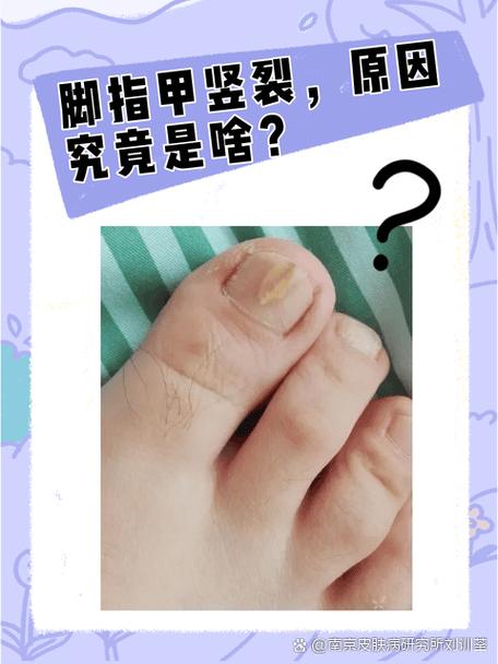 夏天裂脚怎么办
