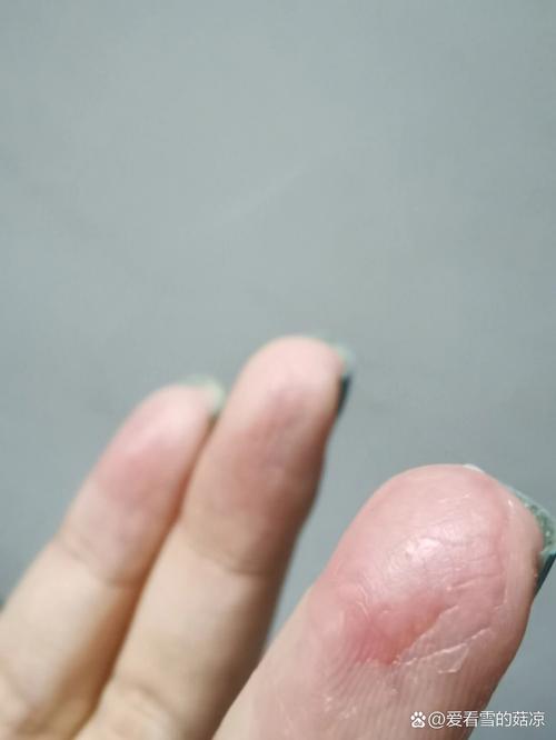 手指没有指纹是什么原因造成的图标
