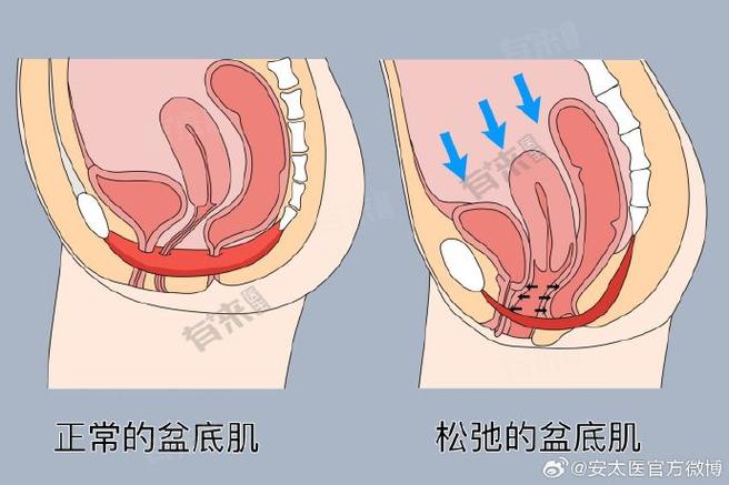 盆底肌松弛图标