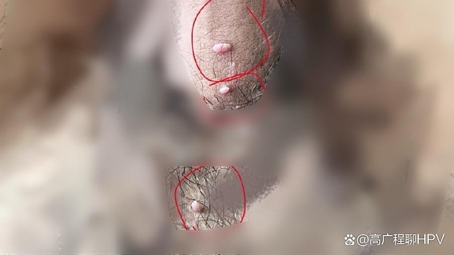 打了两针才发现自己hpv感染图标