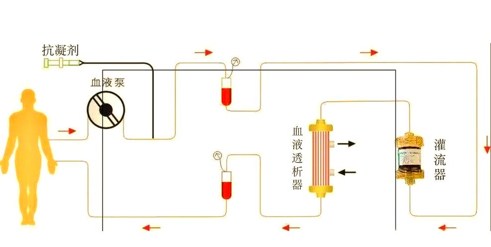 血液灌流是什么意思图标