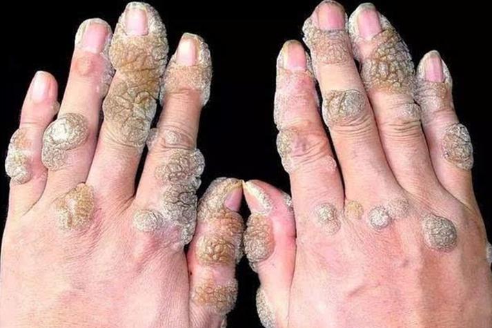 病毒疣是怎样引起的图标