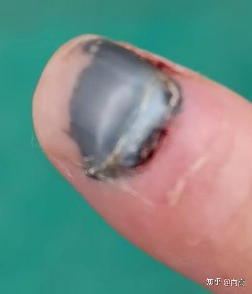 手指甲被夹了几天消肿图标