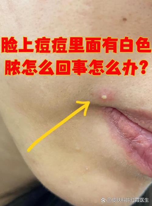痘痘有白色脓点能挤吗图标