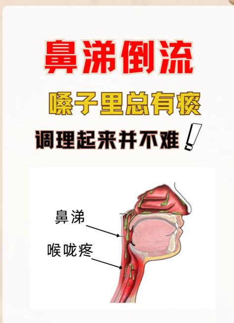 流清水鼻涕吃什么药图标