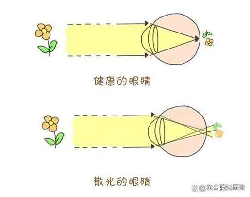儿童散光能矫正吗
